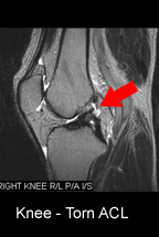 MRI Images - torn ACL and normal ACL