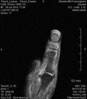 MRI of a thumb? What does an MRI of a thumb look like?