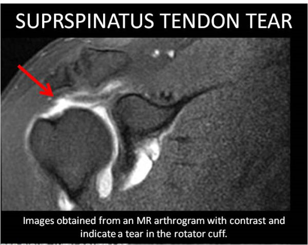 MRI & Rotator Cuff Injuries: when you need one & when you don't.